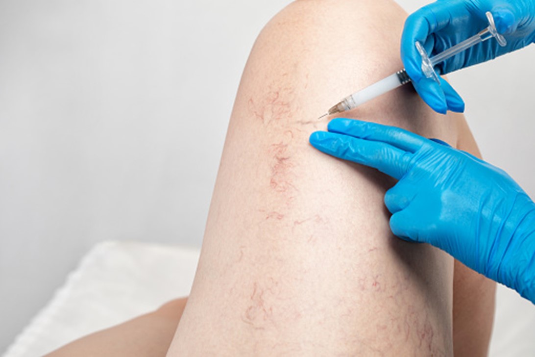 Houston’s Best Varicose Vein Treatments – Fast & Effective!
