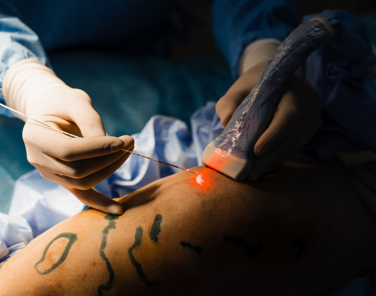 Is Vein Treatment Covered by Insurance?